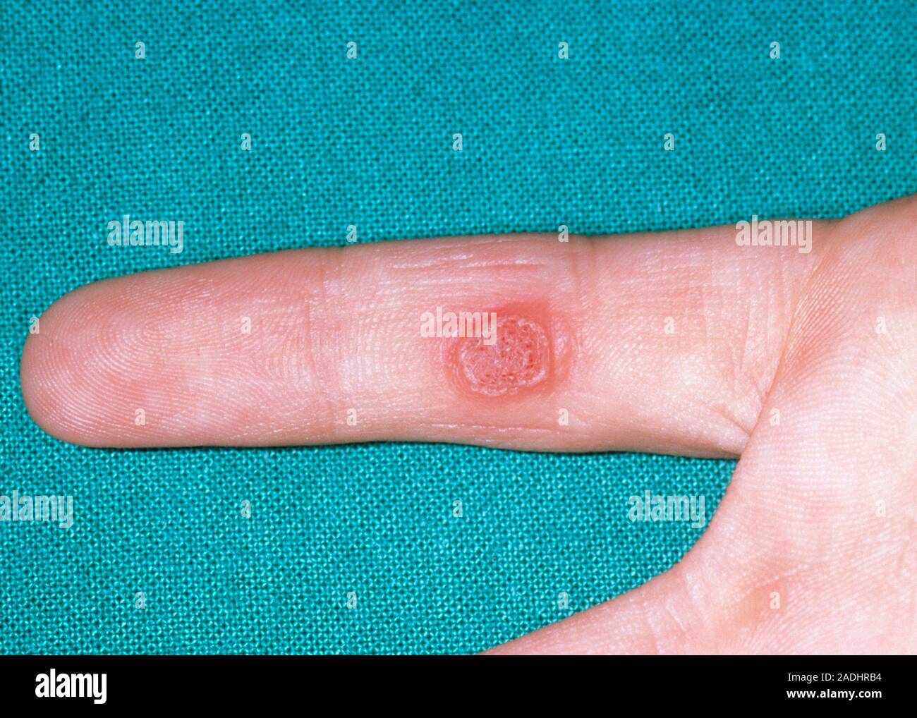 Common wart. A large common wart (medical name: verruca) found on the ...