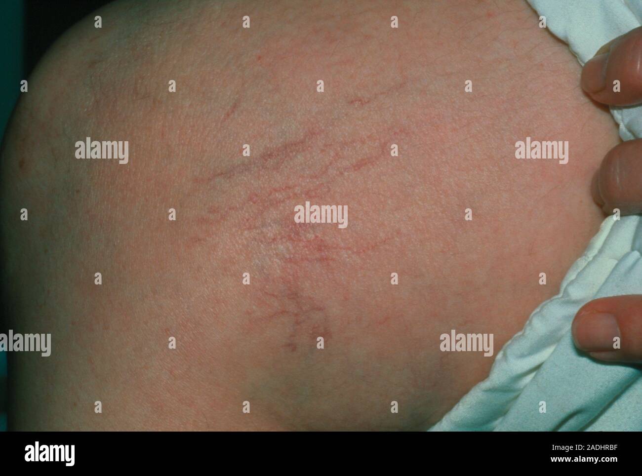 Capillary varices. View of the leg of a middle aged woman, showing ...