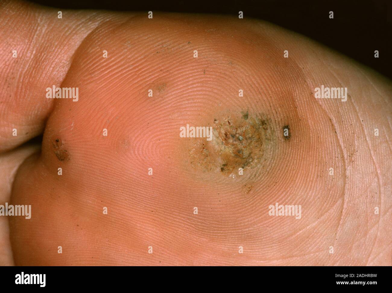 Verrucas on foot. Close-up of the sole of a foot showing several ...