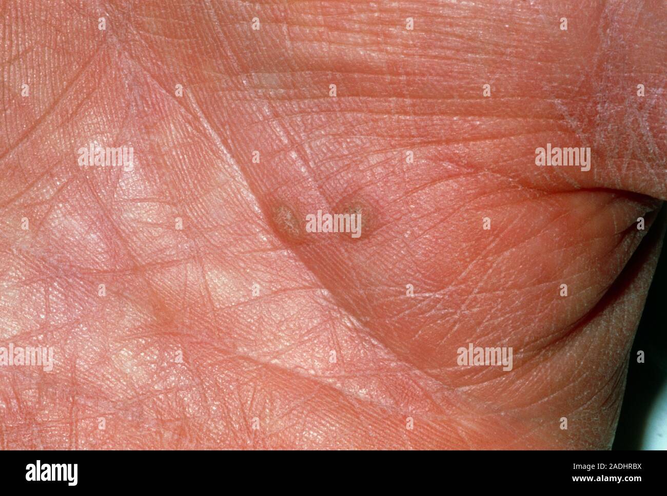 Palmar (hand) warts. View of two warts (verrucas) seen on the palm of a ...