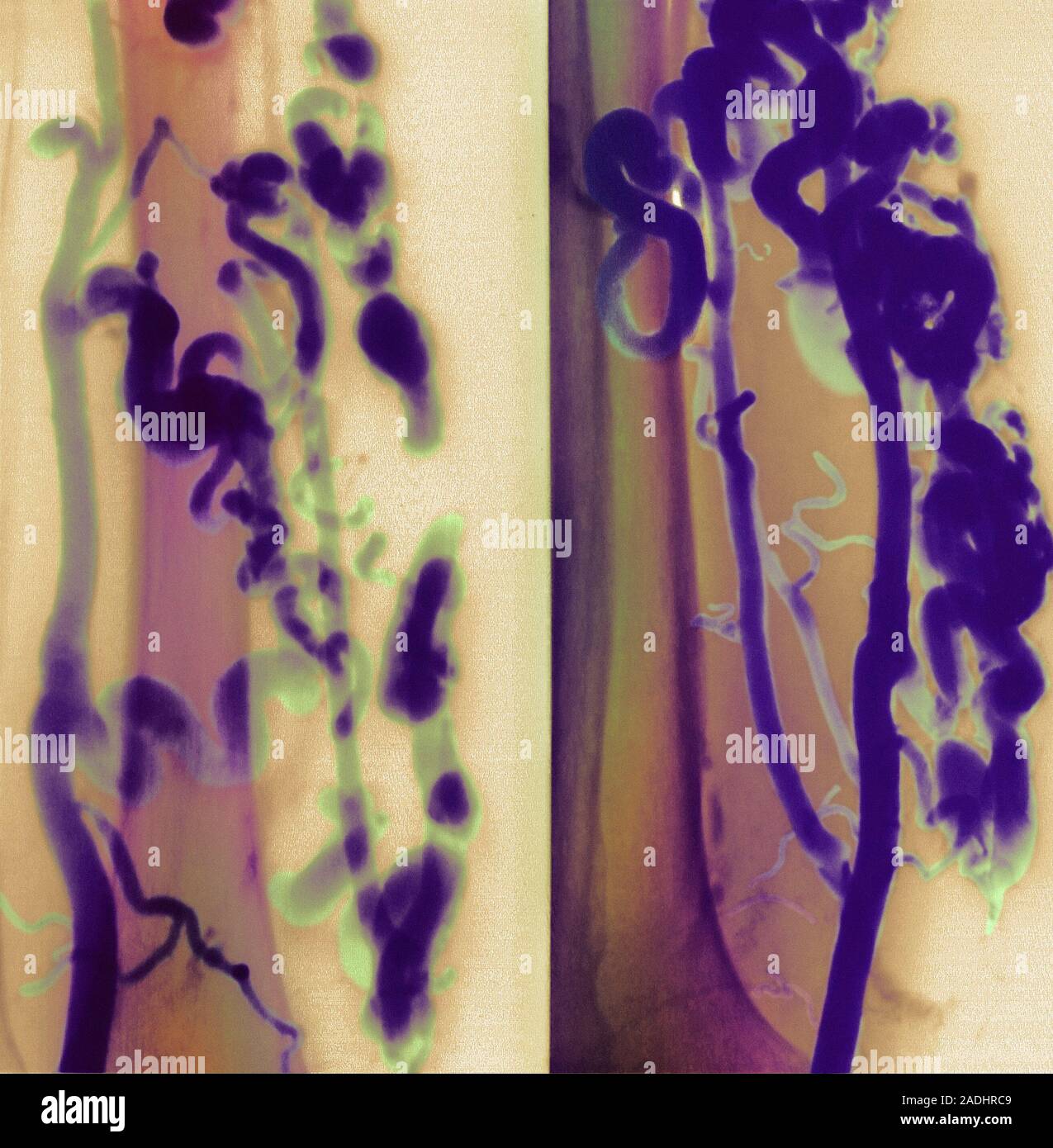 Varicose veins. Coloured angiograms (X-rays) of two views of a leg ...