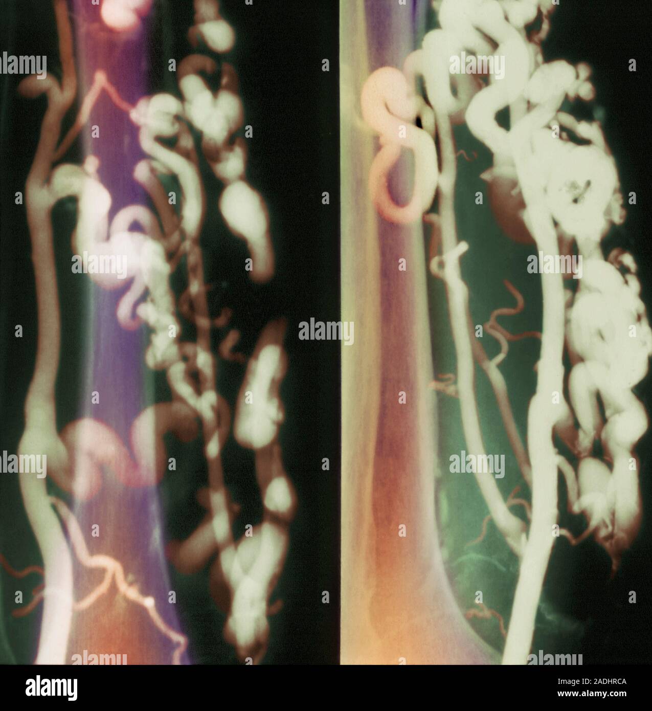 Varicose veins. Coloured angiograms (X-rays) of two views of a leg ...