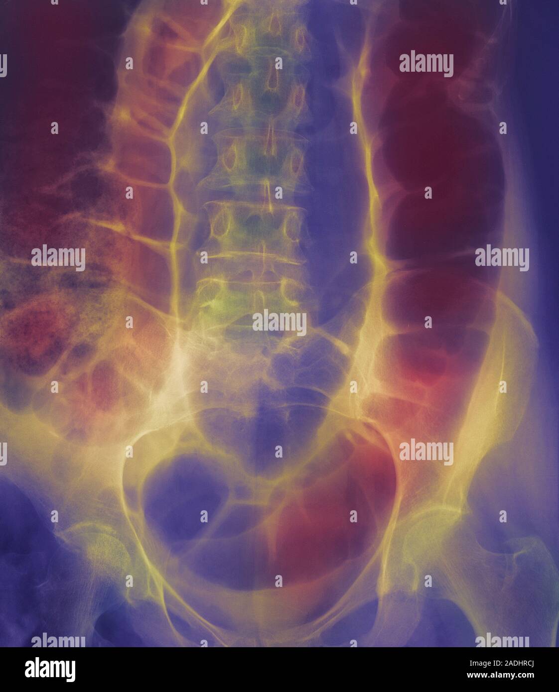 Twisted colon. Coloured X-ray of the abdomen of a patient with a ...