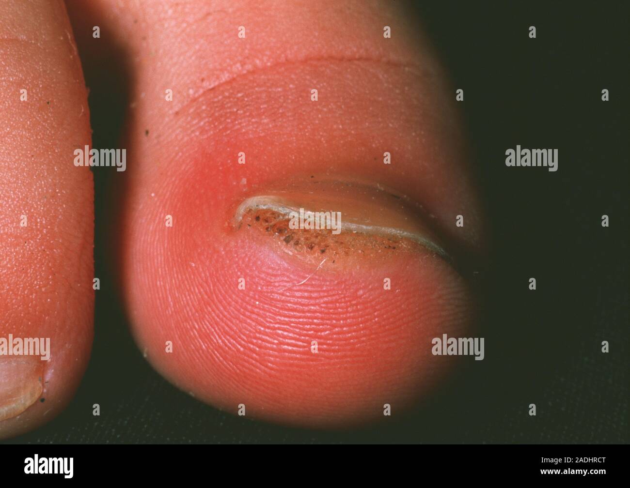 Verruca under the toenail (subungual) of a 4-year- old girl. The ...