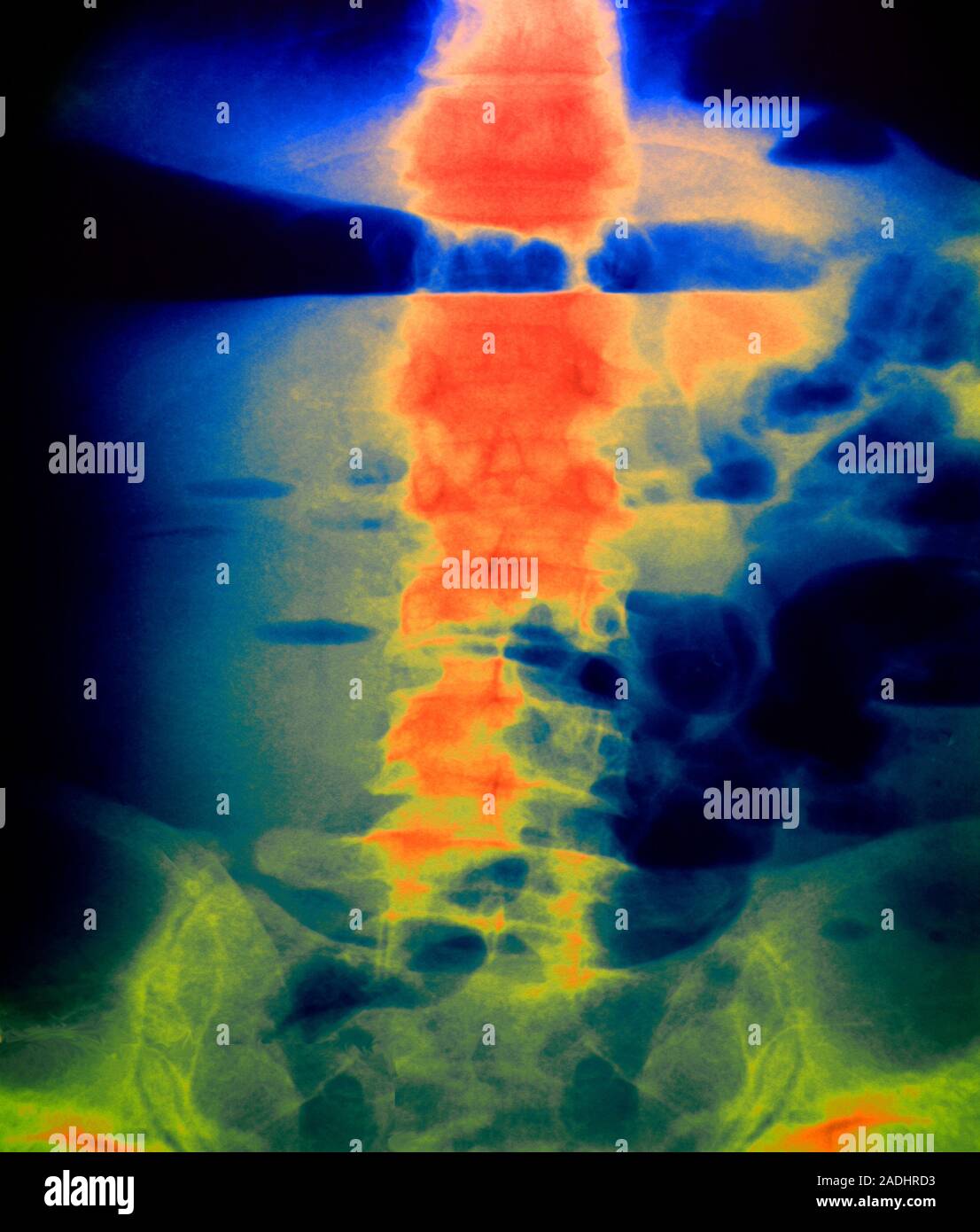Twisted colon. Coloured X-ray of the abdomen of a patient with a ...