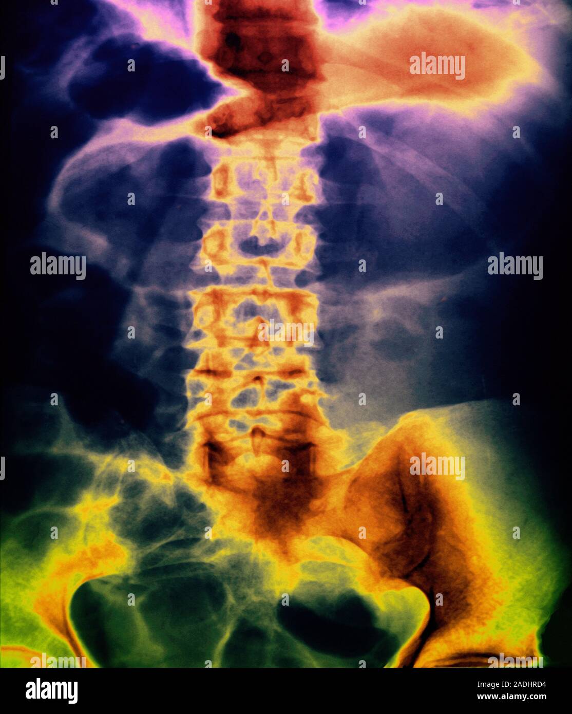 Twisted colon. Coloured X-ray of the abdomen of a patient with a ...