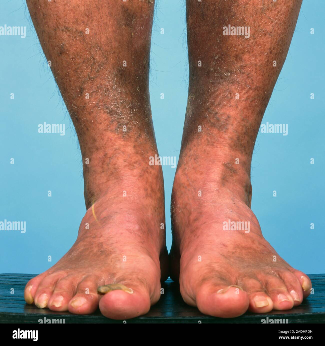 Bruised varicose veins on a man's legs. Varicose veins are veins that ...