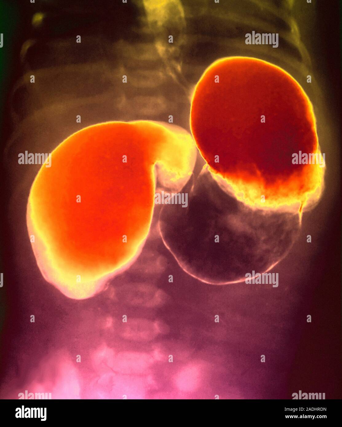 Twisted small intestine. Coloured barium X-ray of the abdomen of an ...