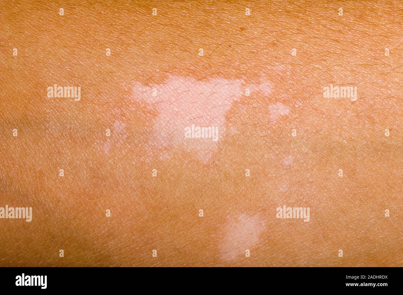 MODEL RELEASED. Vitiligo. Area of light skin on the arm of a 15 year ...