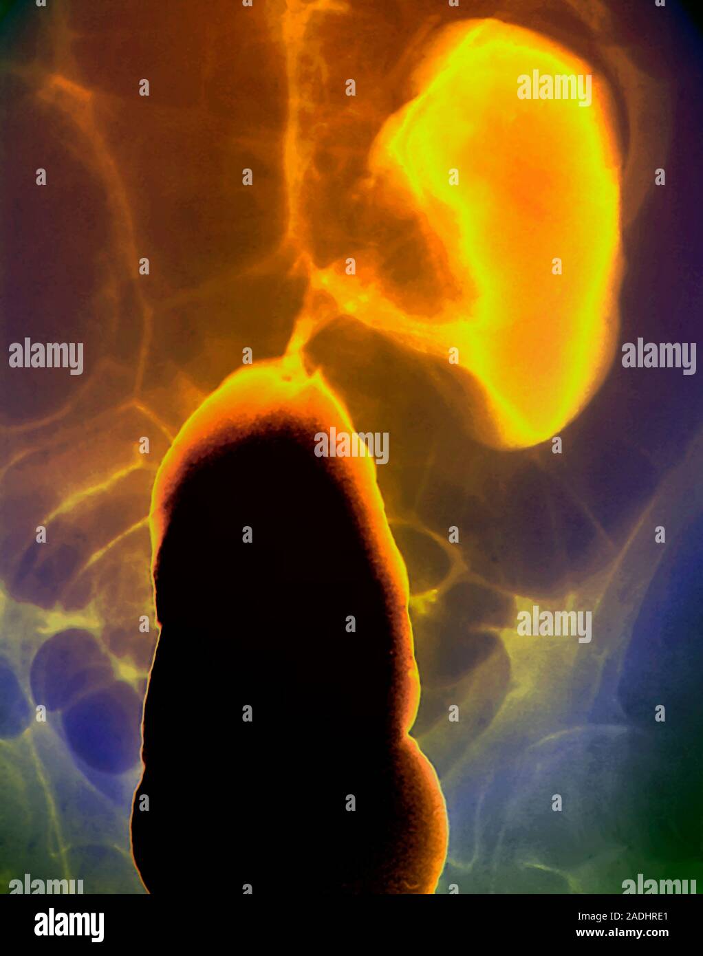 Twisted sigmoid colon. Coloured barium X-ray of the abdomen of a 68 ...