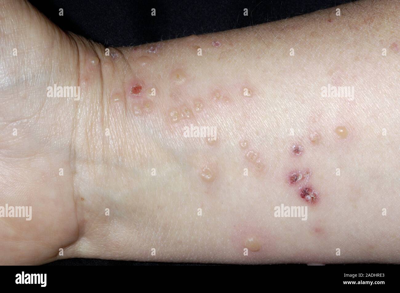 MODEL RELEASED. Vasculitis. Close up of the arm of a 56-year-old woman ...