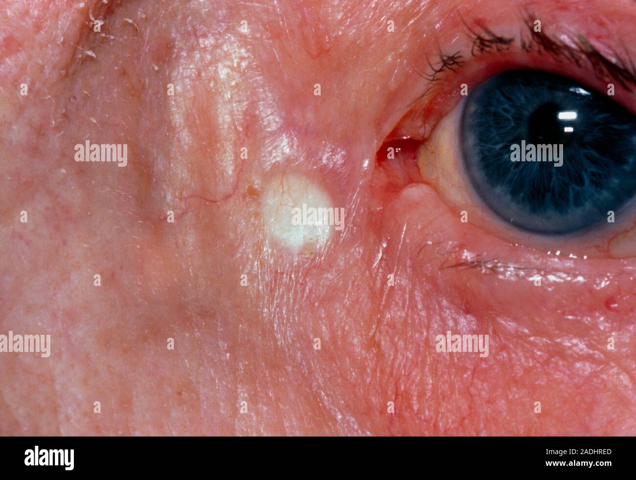 Elderly Woman Affected By Xanthelasma Centre A Disorder Of The Eyelids Characterised By