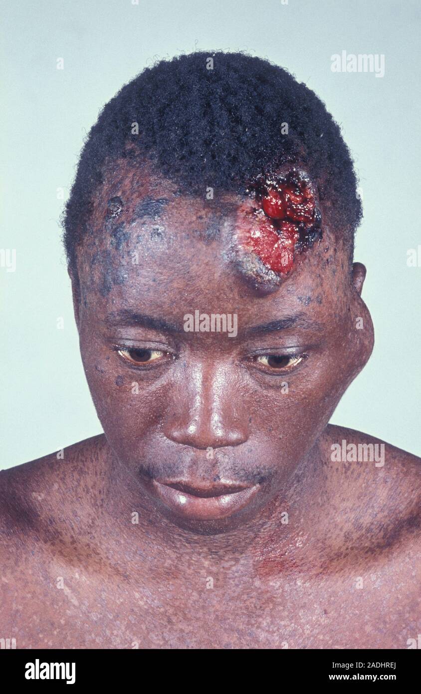 MODEL RELEASED. Xeroderma pigmentosum. Skin cancer on the forehead of a ...