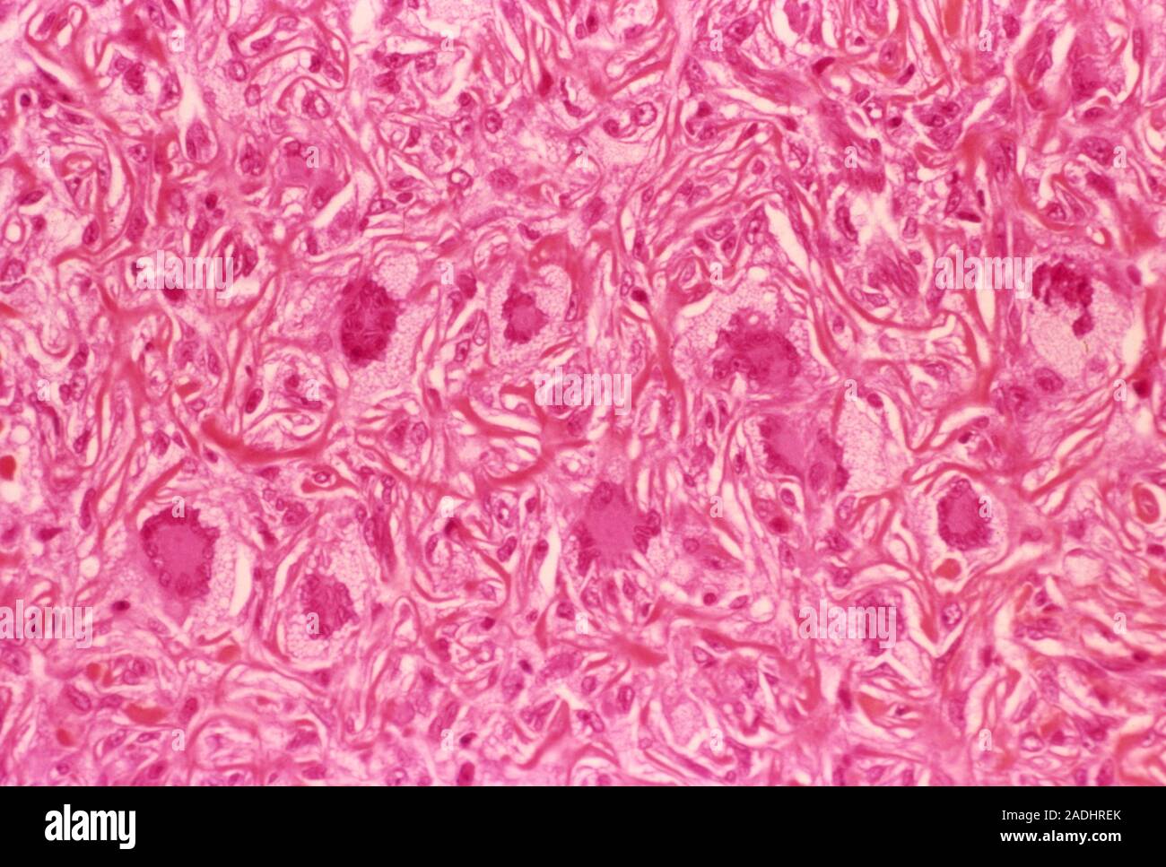 Xanthoma. Light micrograph of a section through a xanthoma. Xanthomas ...