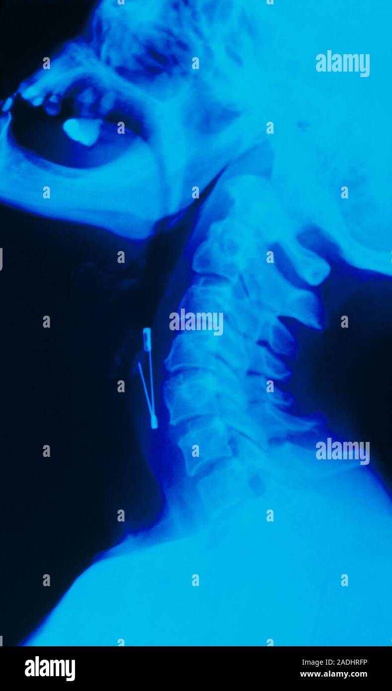 Obstruction in throat. X-ray of an object (safety pin) lodged in the ...