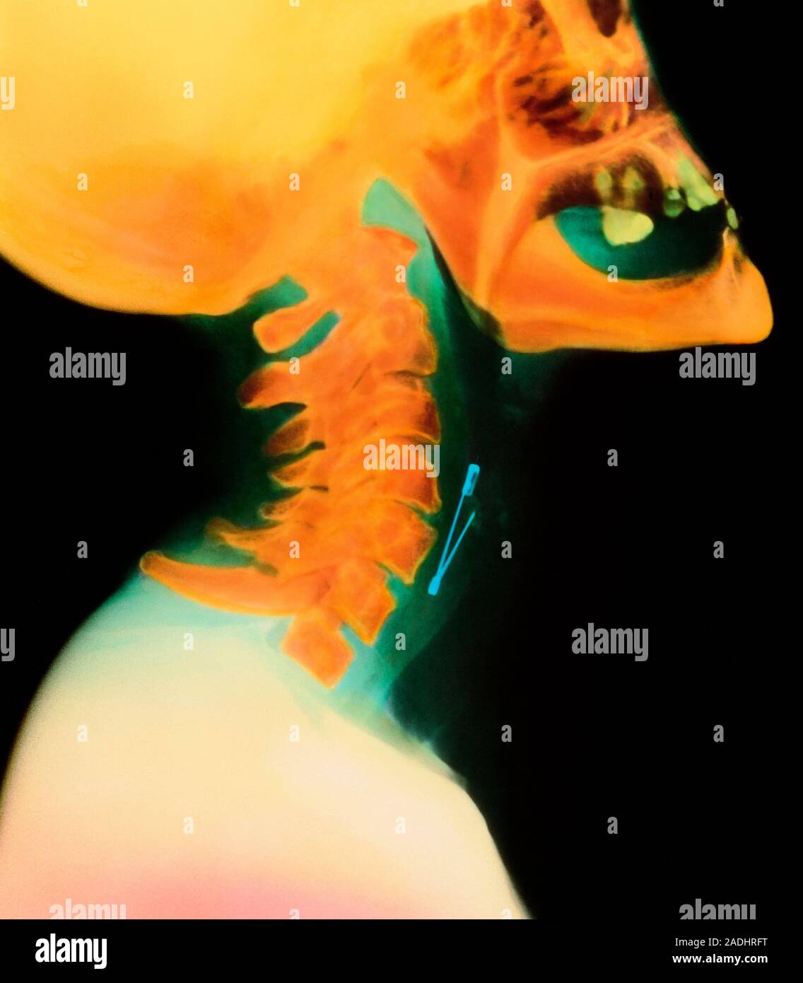 Obstruction in throat. Coloured X-ray of an object (safety pin) lodged ...