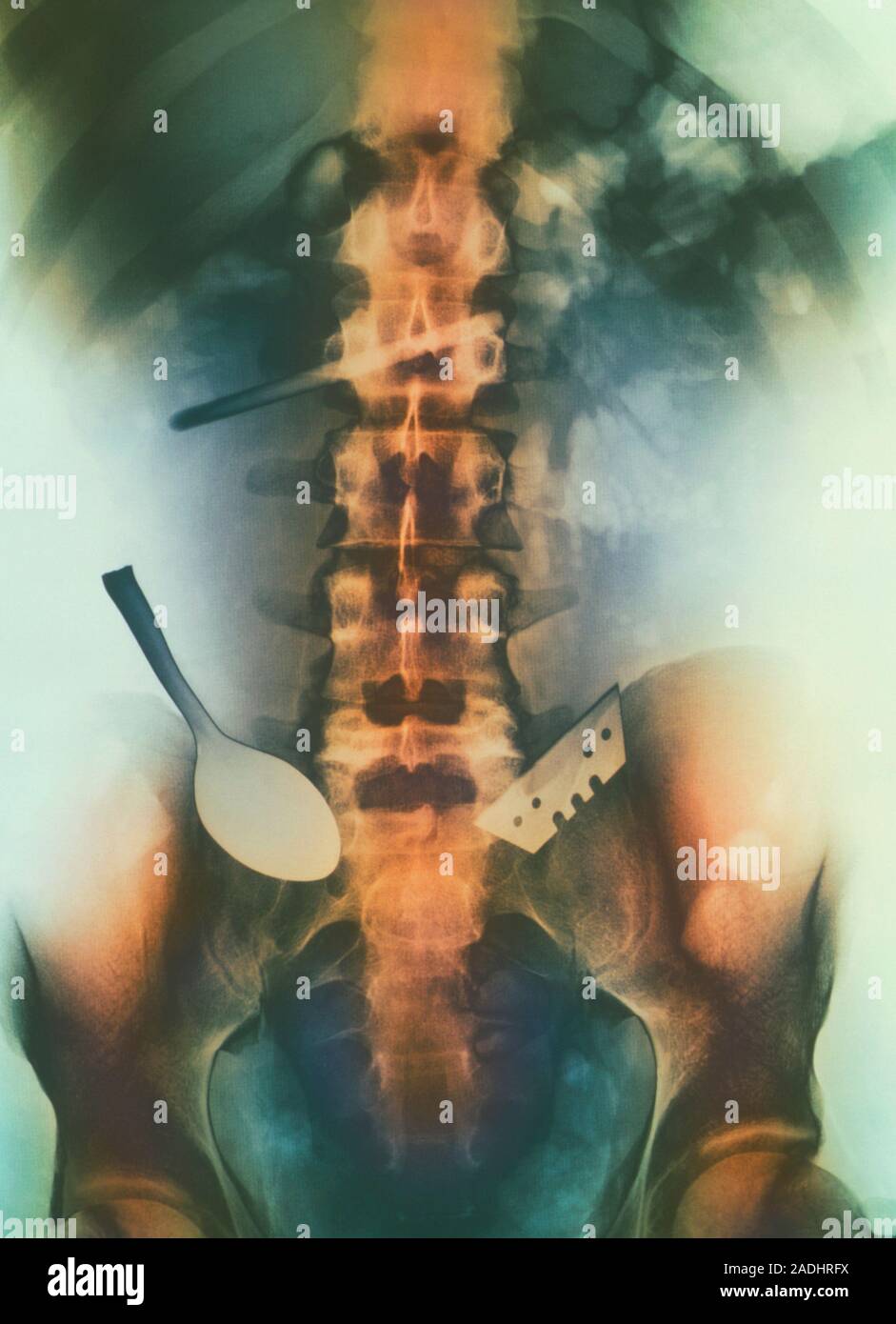 Swallowed objects. Coloured X-ray of objects swallowed and lodged in ...