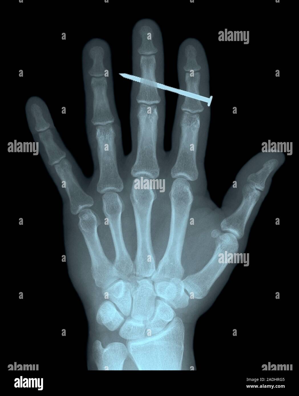 Nail in fingers. X-ray of a nail (upper centre) lodged in bones of the ...