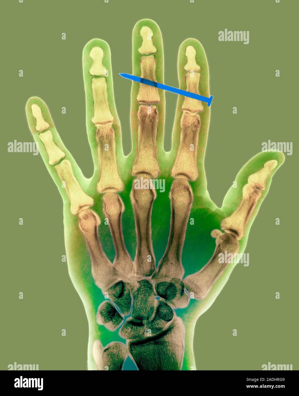 Nail in fingers. Coloured X-ray of a nail (upper centre, blue) lodged ...