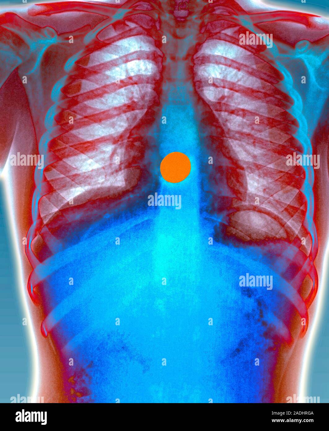 Swallowed coin. Coloured X-ray of a coin (orange) in a child's ...