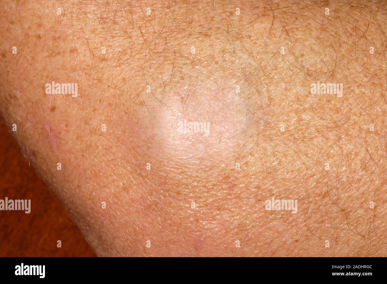 Skin depigmentation. Light patch of skin on the elbow of a 56 year old ...