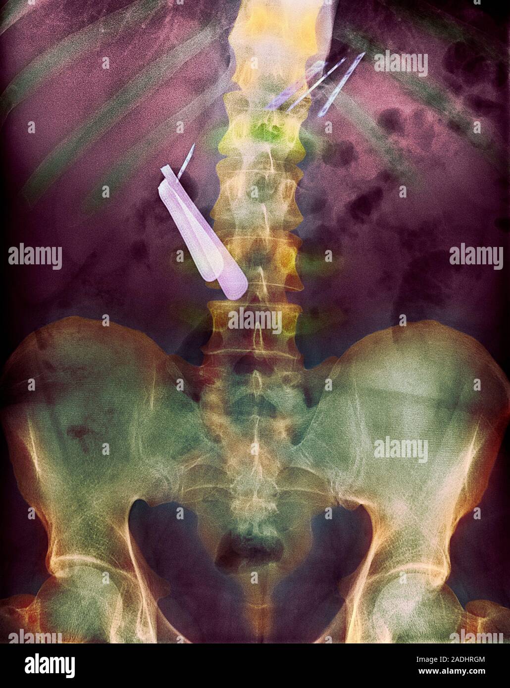 Swallowed razor and razor blades. Coloured X-ray of the abdomen of a ...