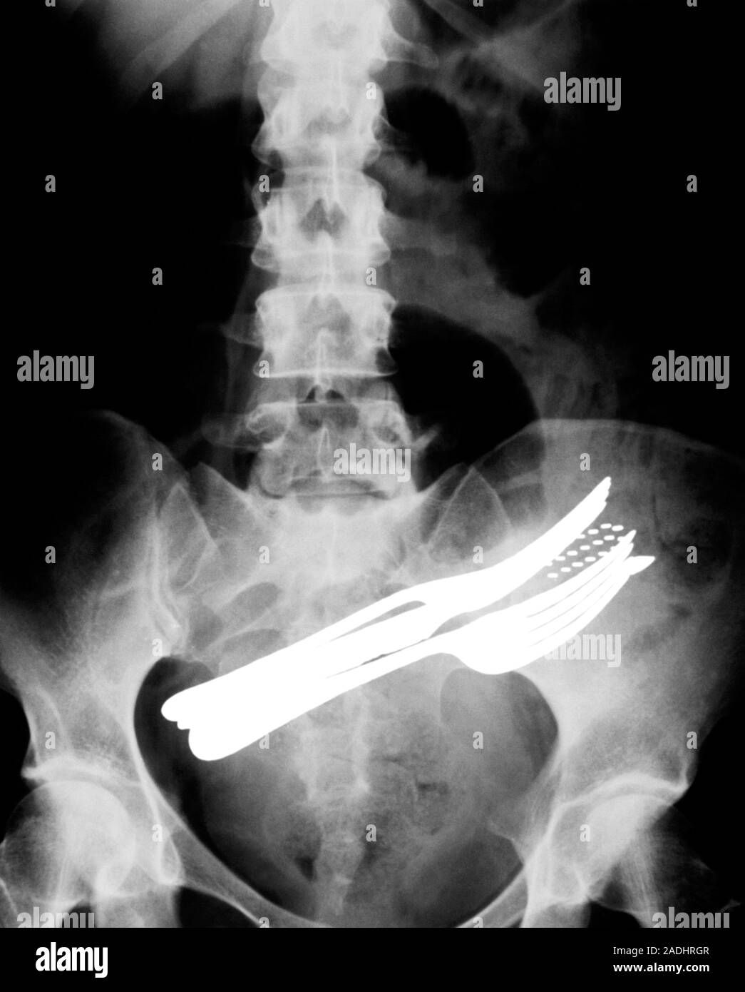 Swallowed household objects. X-ray of the abdomen of a patient that has ...