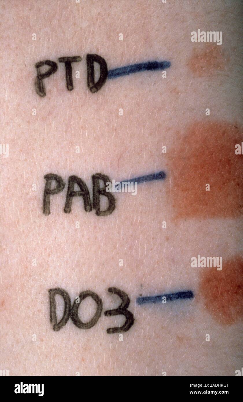 Allergy testing of hair dyes, showing skin inflammation caused by three ...