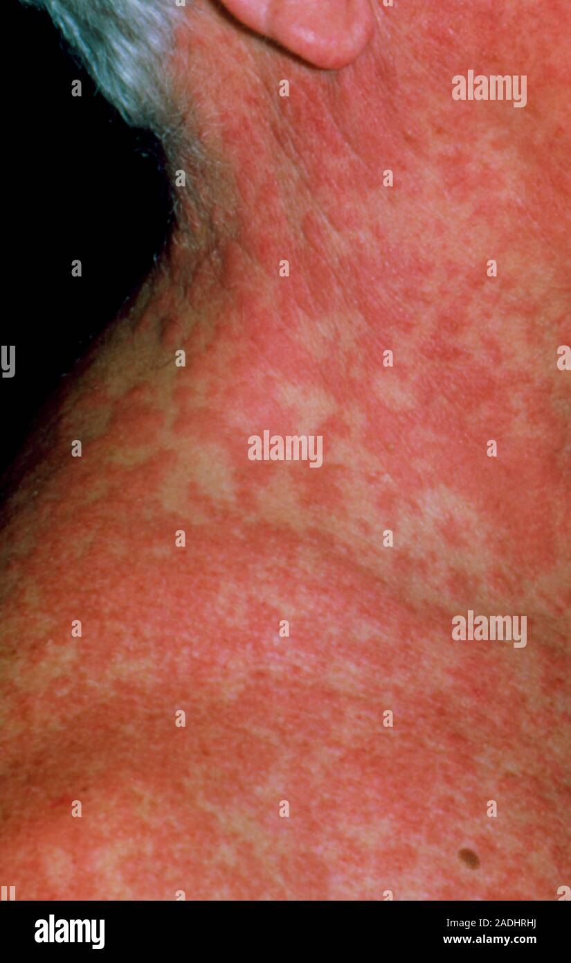 Extensive Rash Over A Mans Neck And Upper Chest Erythema Due To An Allergic Hypersensitive
