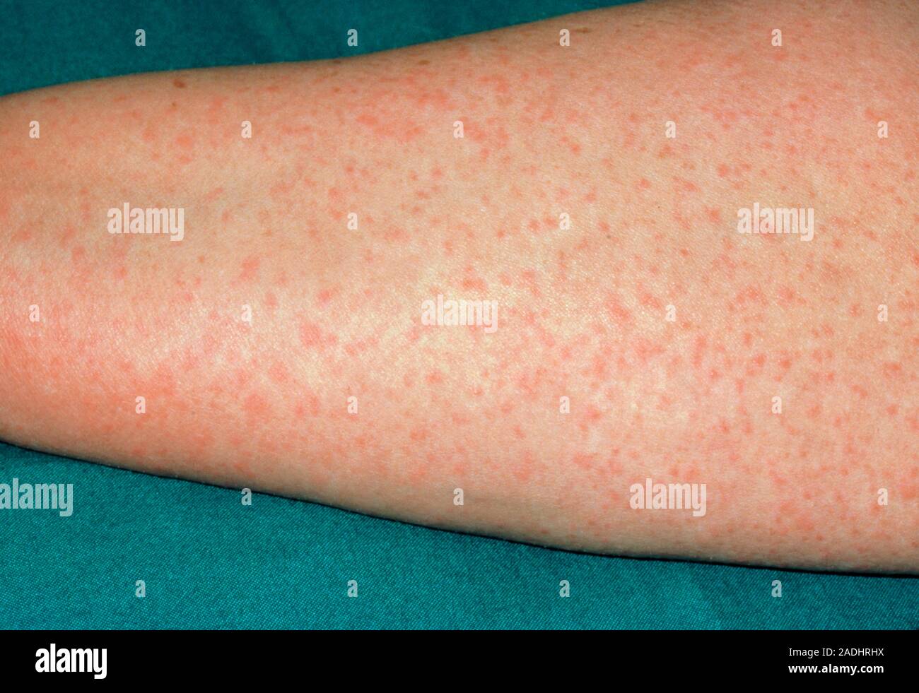 Red rash due to an allergy to penicillin. This is a mild example of ...