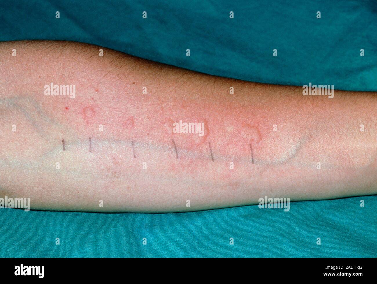 Allergy testing. View of a skin prick test on the inner arm. Small ...