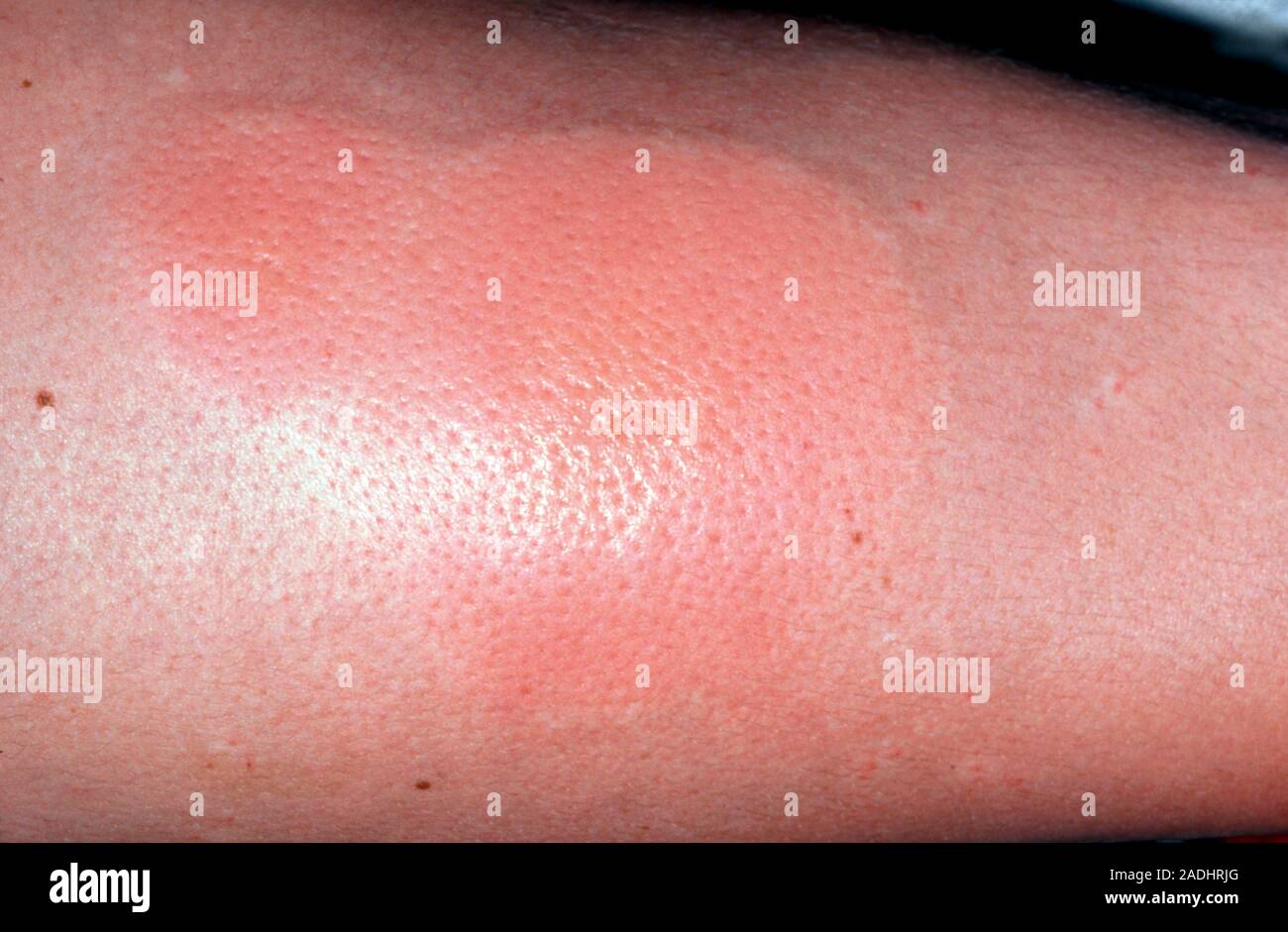 Insect bite rash. Close-up of a pink rash on a patient's arm following ...