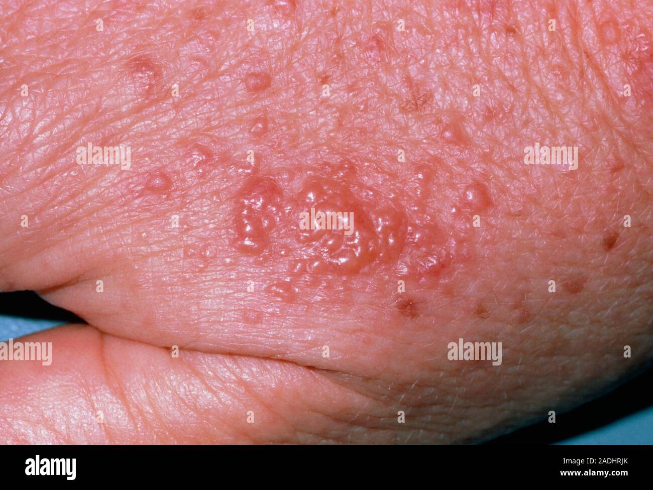 Penicillin allergy. A red rash on the skin of a patient's hand, caused ...
