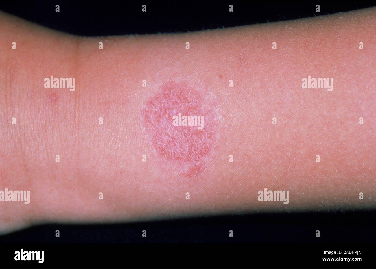Dermatitis due to wristwatch allergy. A circular red rash on a patient ...
