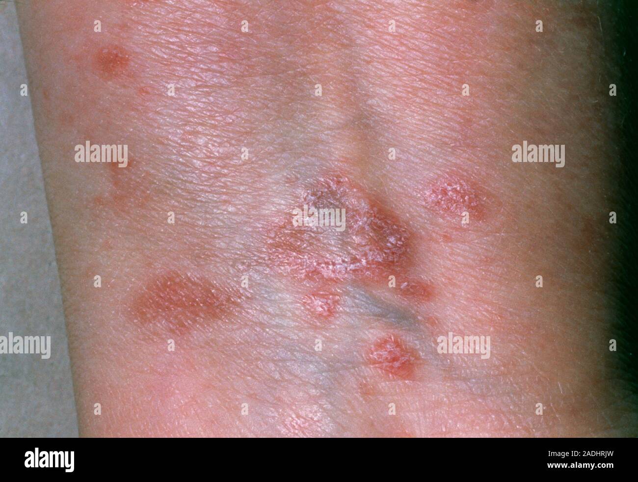 Lichenoid rash from drug. Close-up of raised red patches on a patient's ...