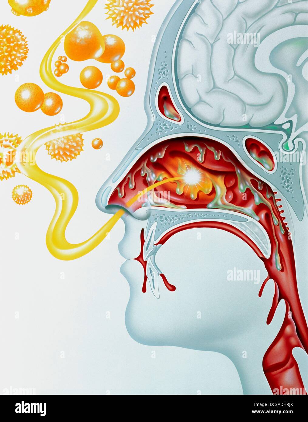 Hay fever. Illustration of excessive mucus production in the human nose ...