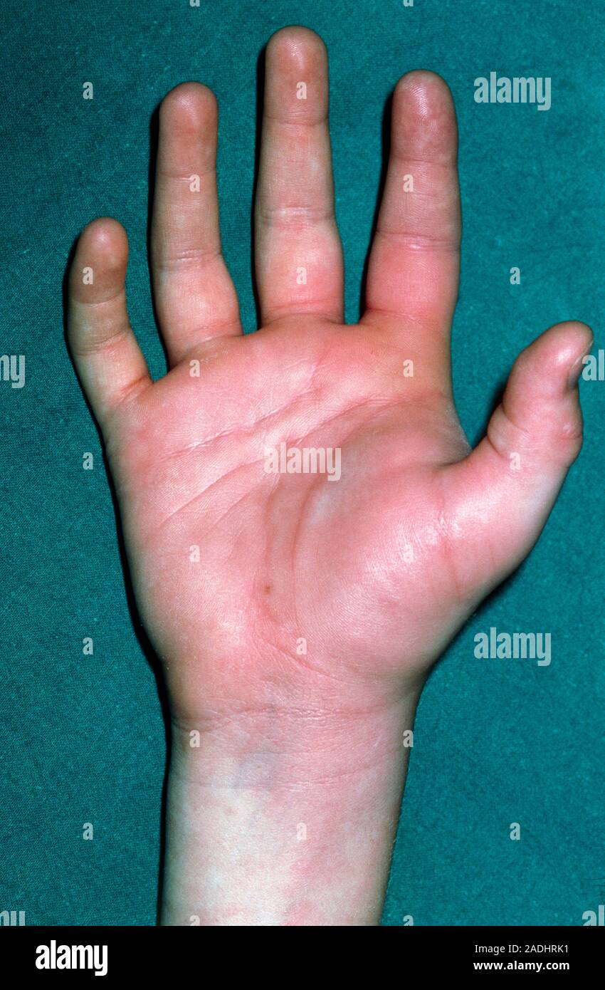 Infected wasp sting on hand. Swollen hand of a five year old girl, due ...