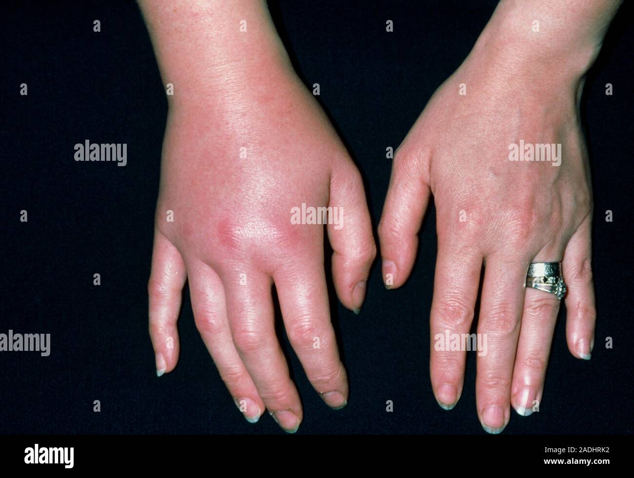 Infected insect sting on hand. Swollen hand (at left) of a woman aged ...