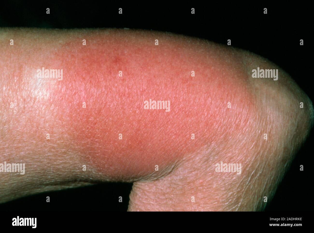 Flu vaccine reaction. Skin inflammation on the arm of a 70-year-old ...