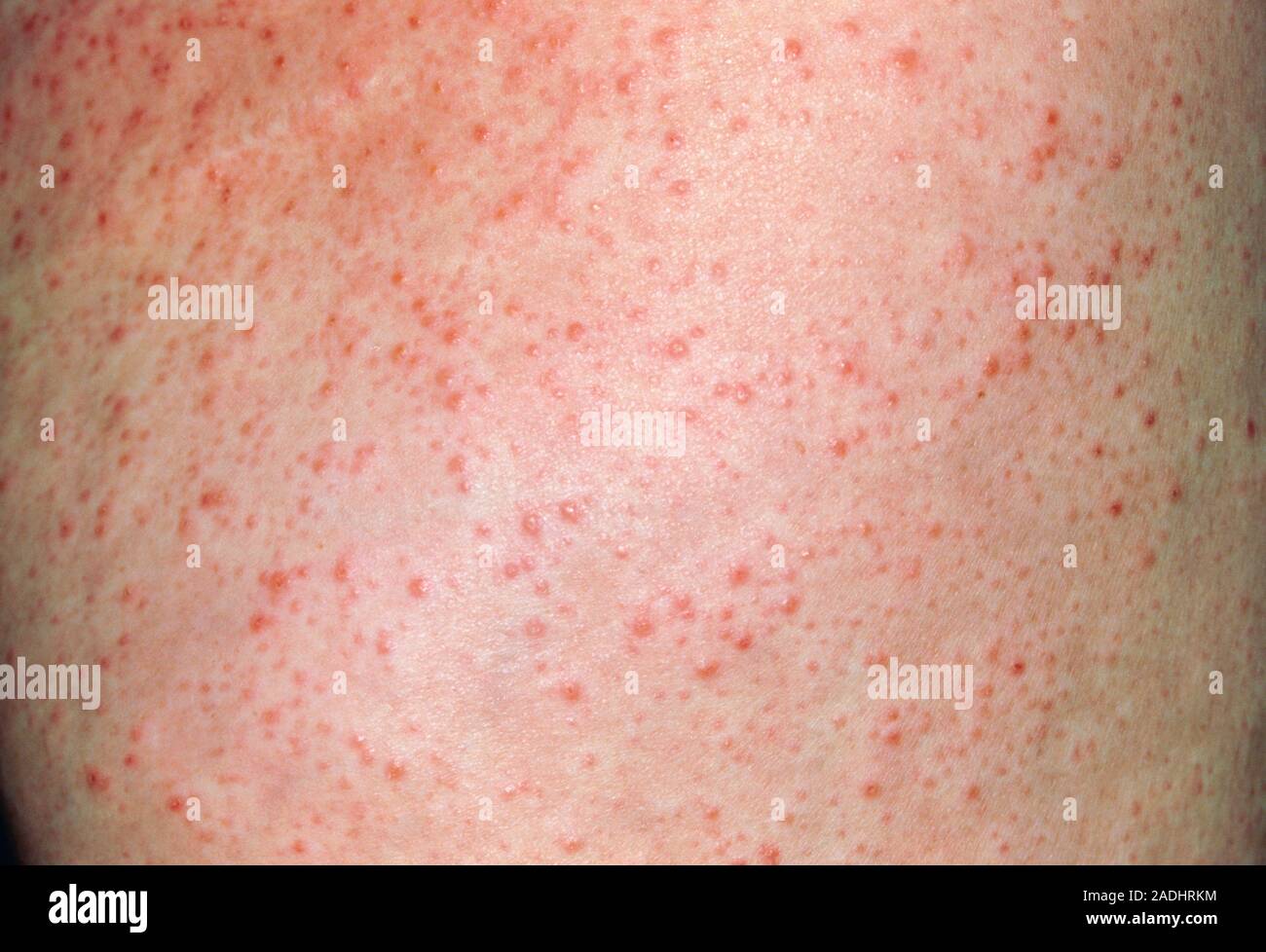 Allergic reaction to cosmetic cream. A red rash on the body of a 49 ...