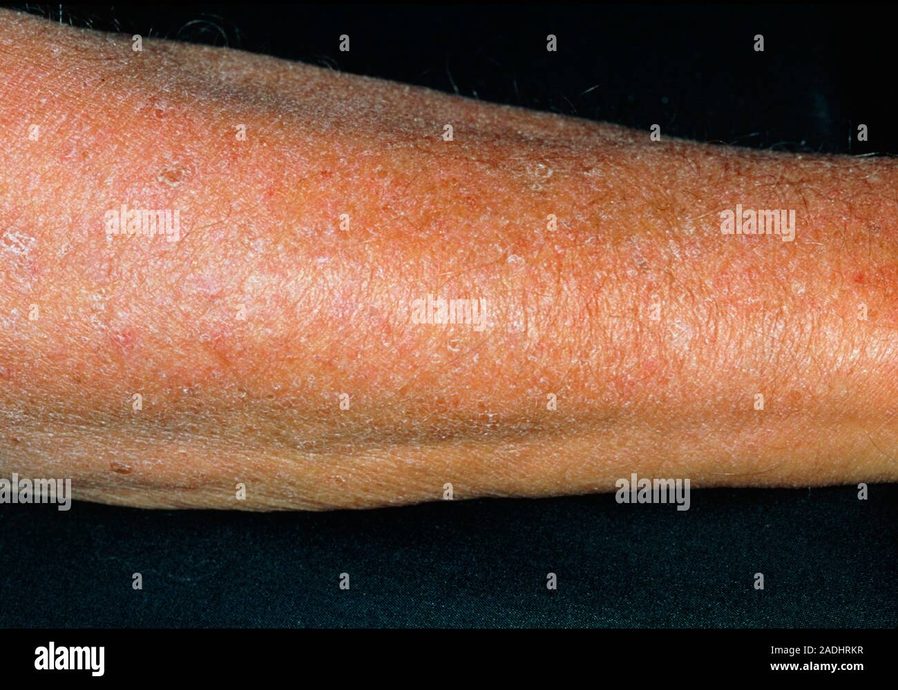 Allergic reaction to anti-convulsant drug. A red rash on the arm of a ...