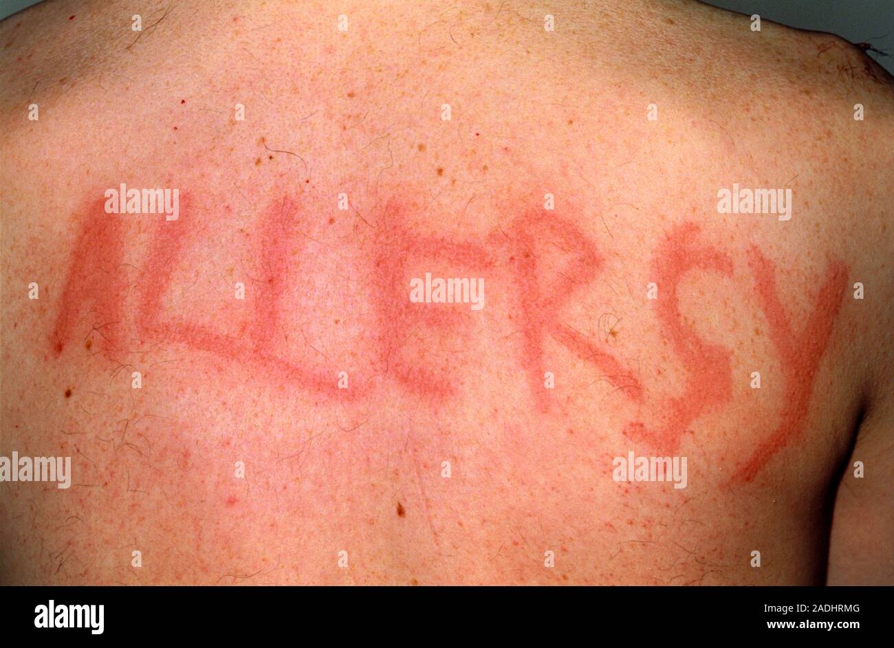 Dermatographic Urticaria Dermographism (Dermatographic Urticaria)