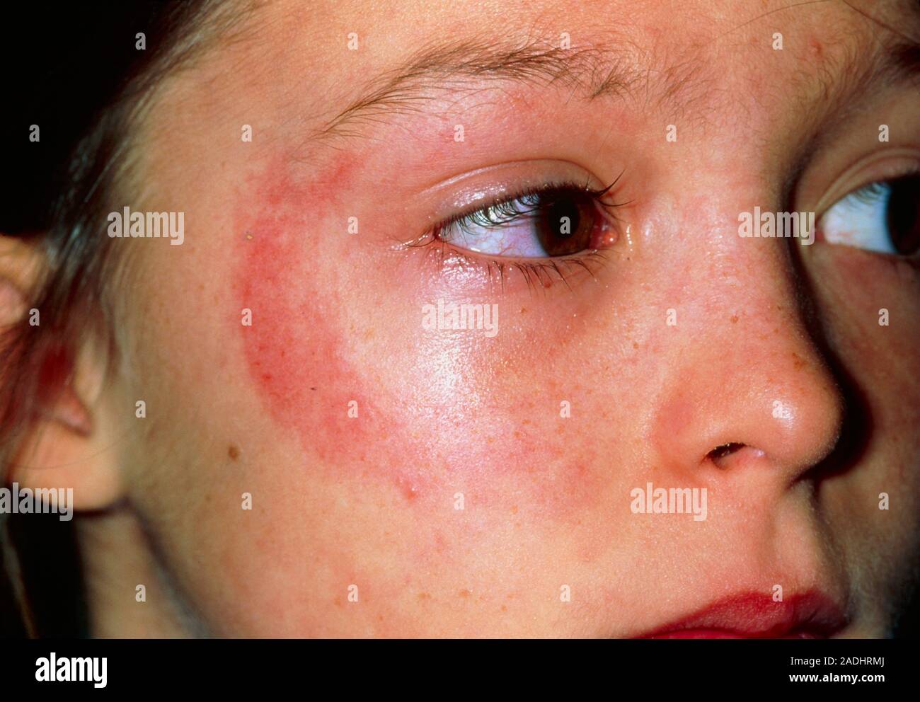 Facial allergy. Rash on an 8 year old girl's face caused by an allergy ...