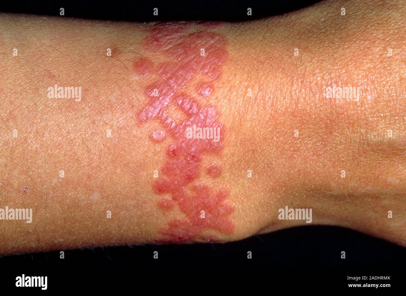 Rash. Close-up of a 39 year old woman's wrist showing a rash at the ...