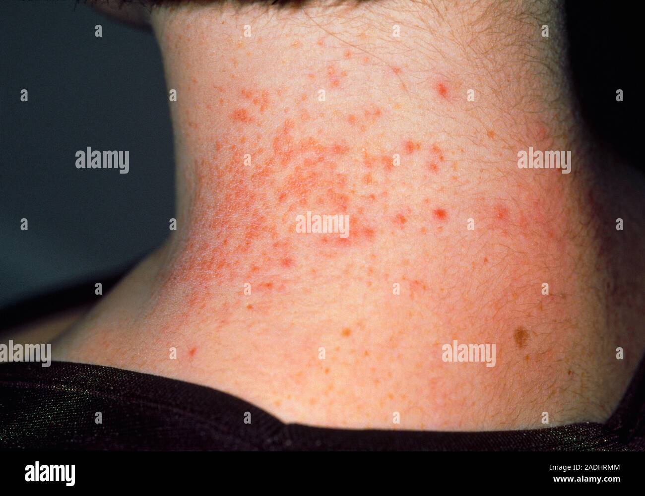 Contact Dermatitis Close Up Of The Neck Of A 17 Year Old Girl Showing A Rash Caused By An