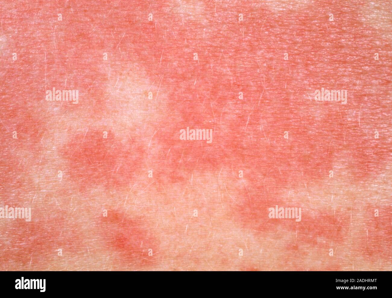 Rash from food allergy. Red rash seen on the skin of the arm caused by ...