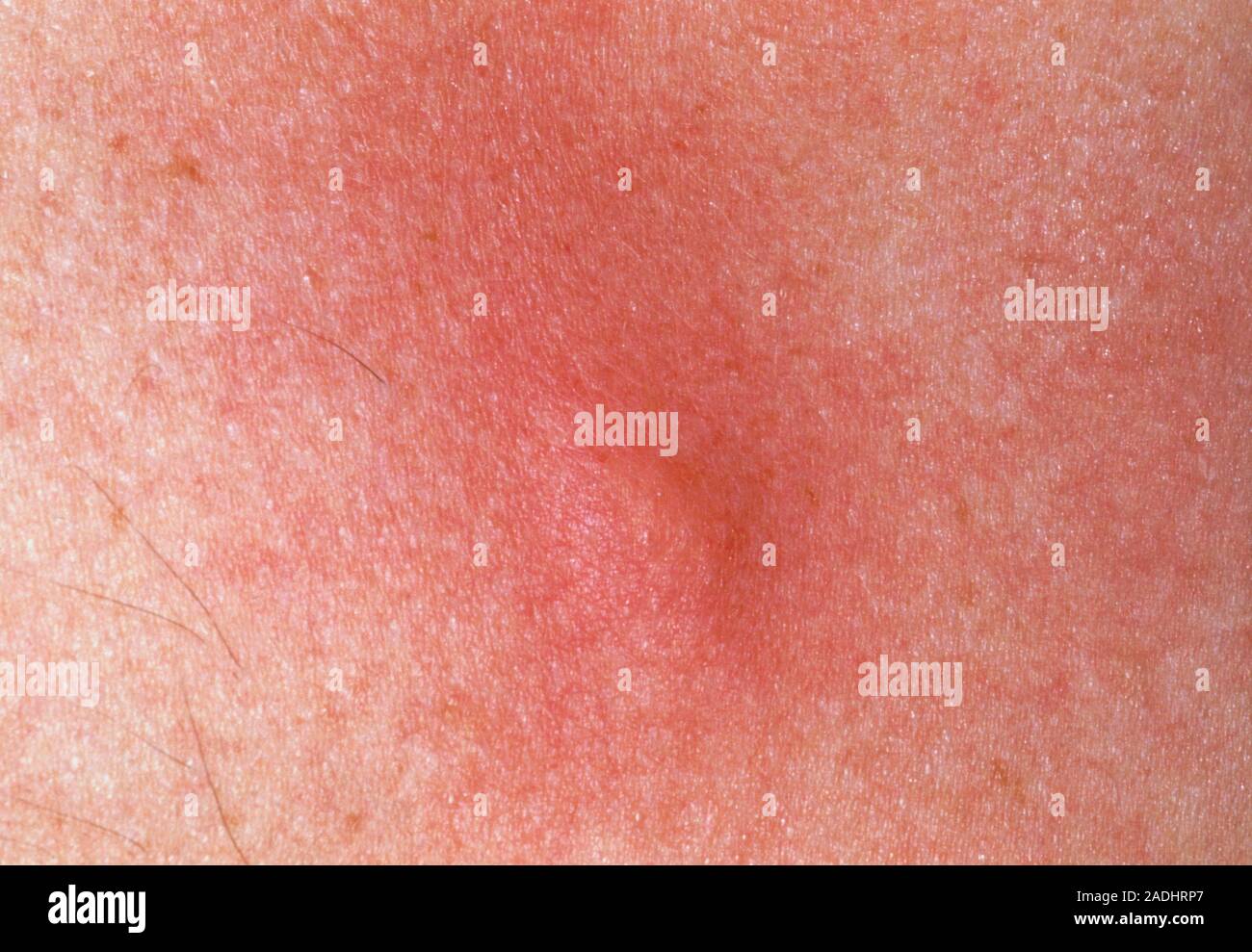 Mosquito bite. Close-up of an aggravated mosquito bite on a patient's ...