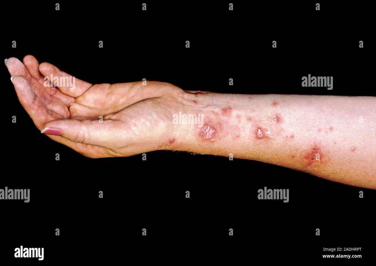 Ivy allergy. Arm of a woman with an inflamed rash caused by an allergic ...