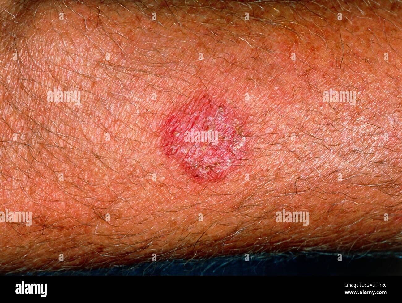 Wristwatch allergy. Circular red rash on a 50 year old man's wrist ...