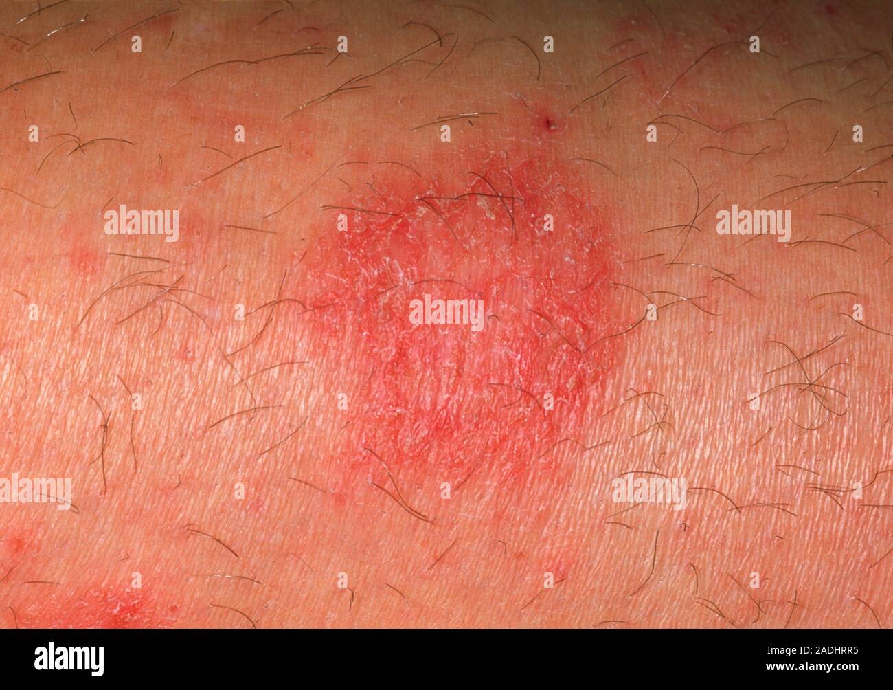 Drug allergy on the skin of a 40-year-old woman. This eczema has ...